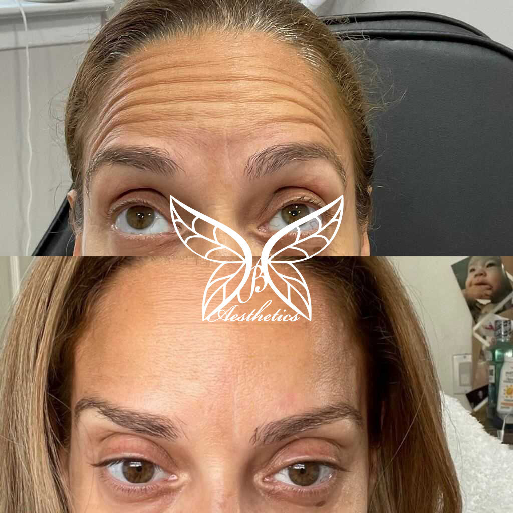 Before & After - Butterfly Aesthetics